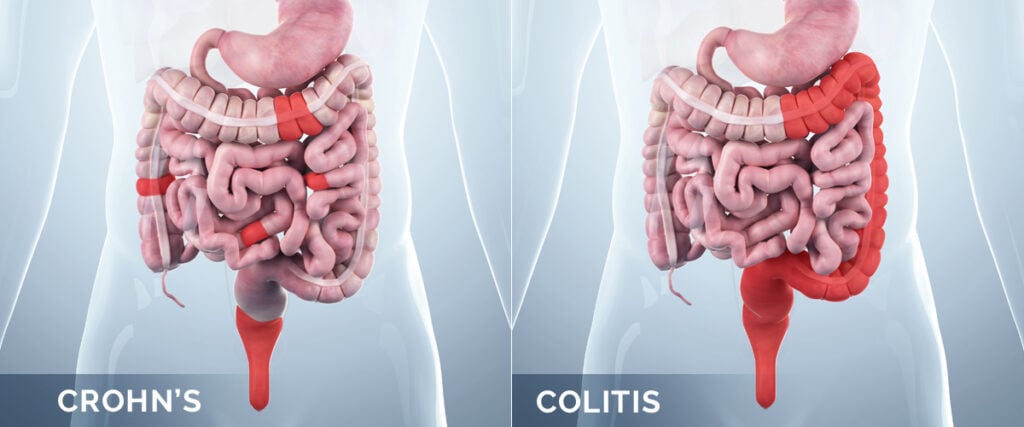 Crohn's Disease Guidelines and Management Tips