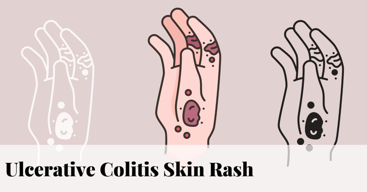 Ulcerative Colitis Skin Rash