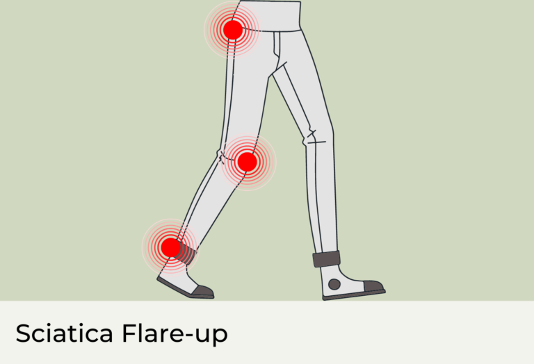 Sciatica Flare Up: Pinching of a Crucial Nerve