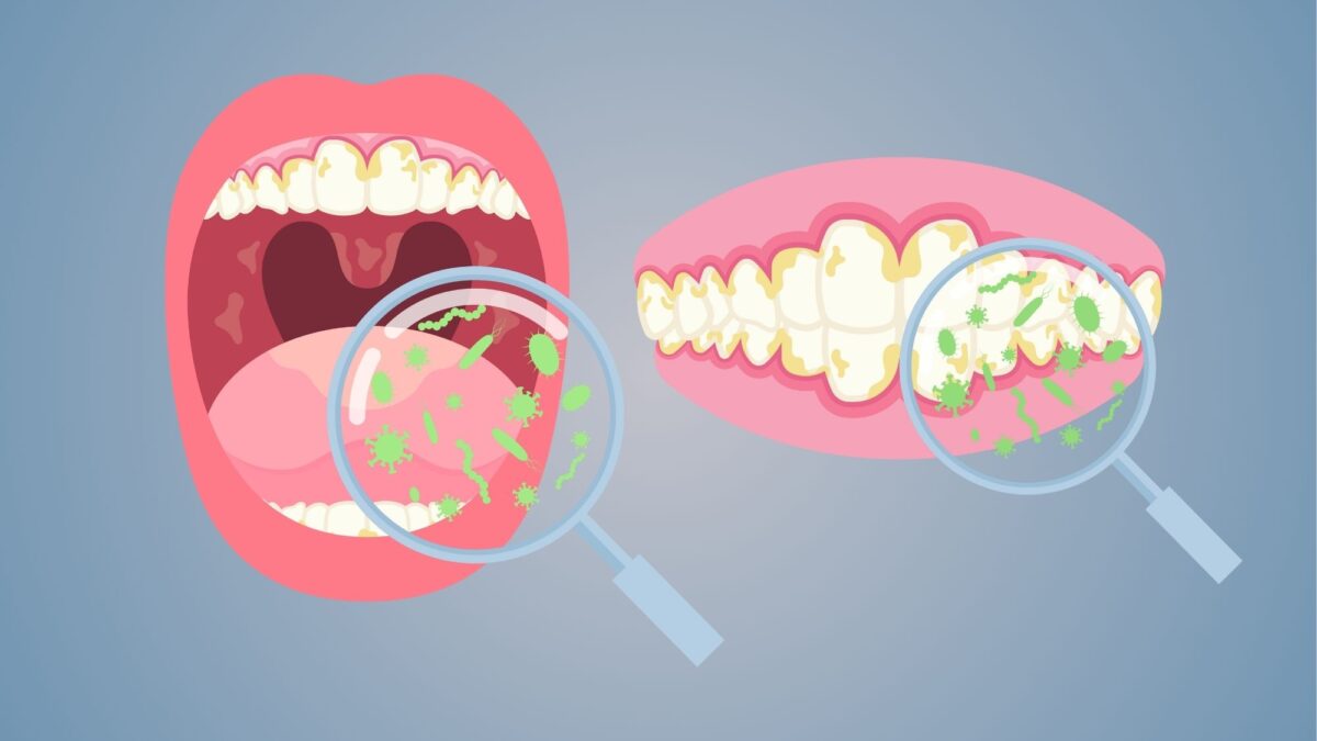 Effective Sjogren's Dry Mouth Remedies